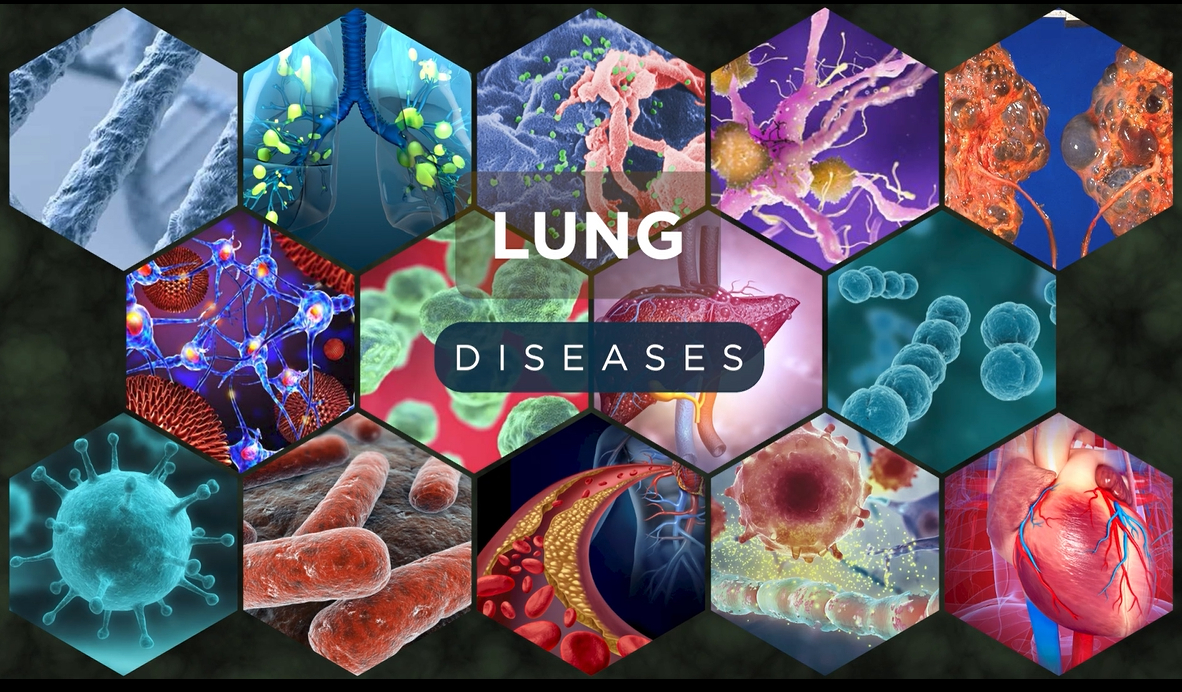 Lungs Diseases Explained – Causes, Symptoms, & Treatments | European ...